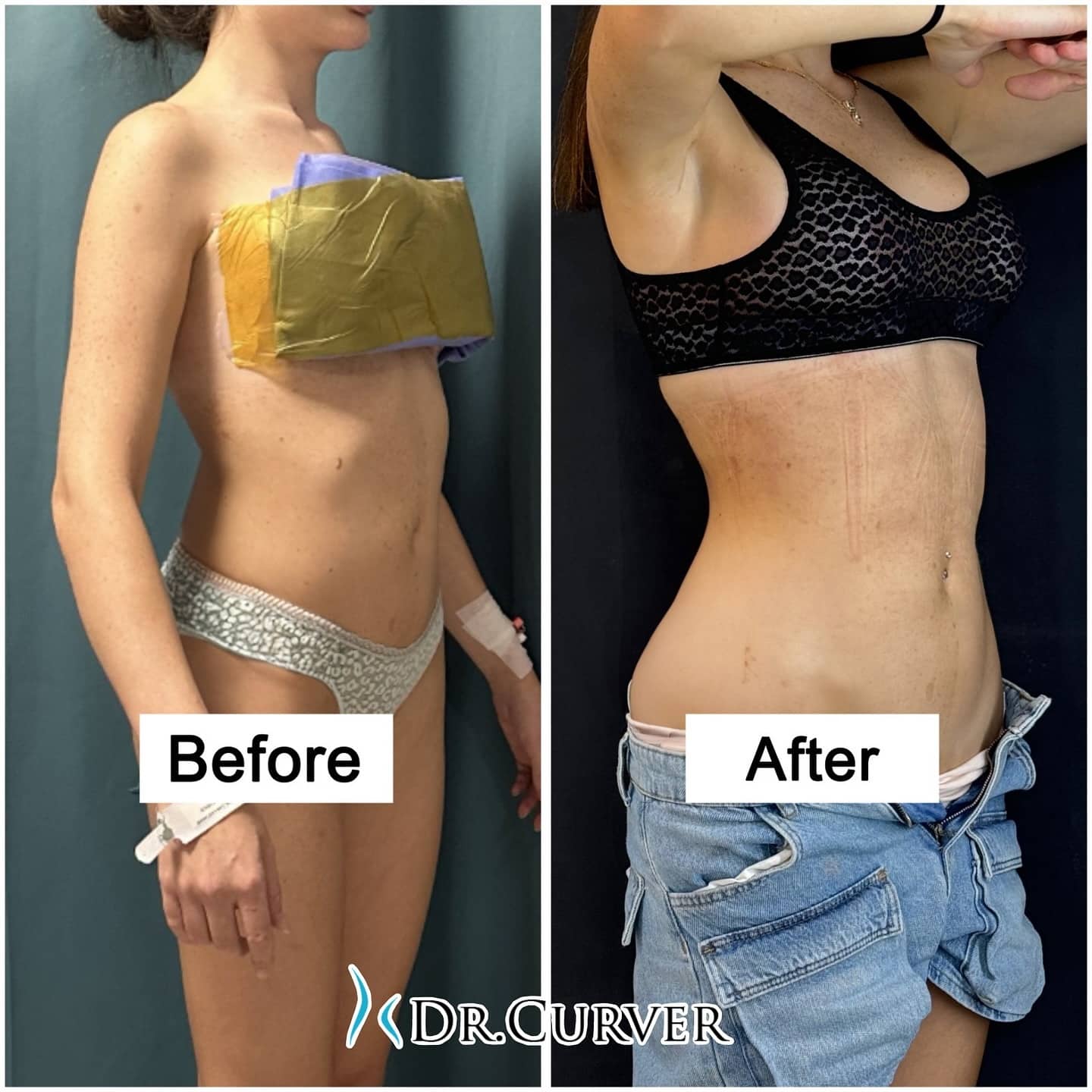 Rib Removal Surgery Cost in Turkey - Universal Medical Travel